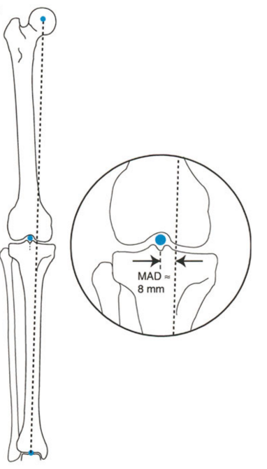 Mechanical Axis Deviation (MAD) and Hip-Knee-Ankle angle (HKA)