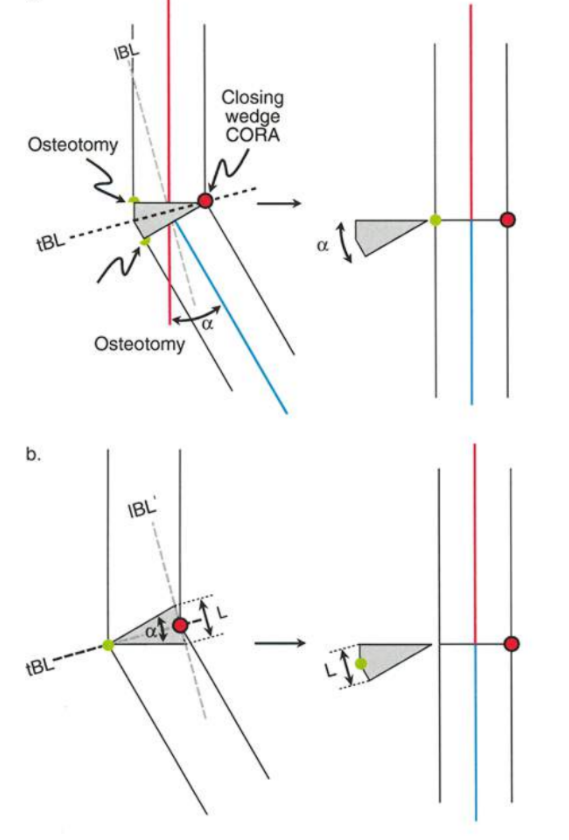 Rules Of Bone Osteotomy - Appropedia, the sustainability wiki