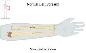 Pediatric Distal Forearm Fractures/Anatomy Review