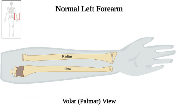 Pediatric Distal Forearm Fractures/Anatomy Review