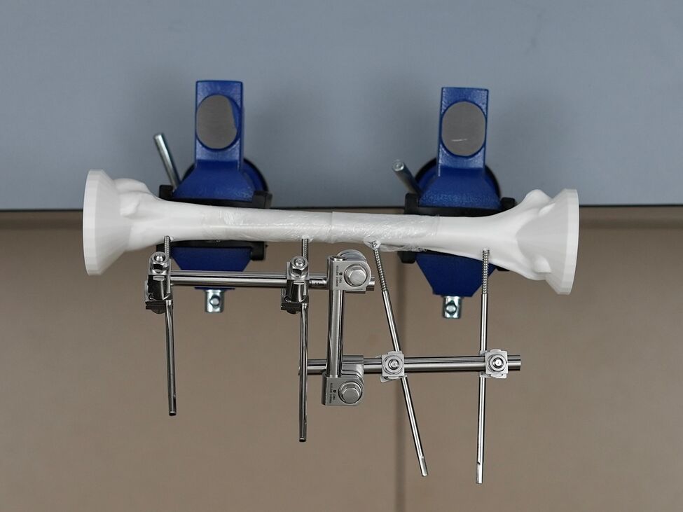 Humeral Fracture Fixation - Appropedia, the sustainability wiki