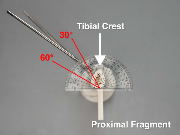 Uniplanar External Fixation Knowledge Review