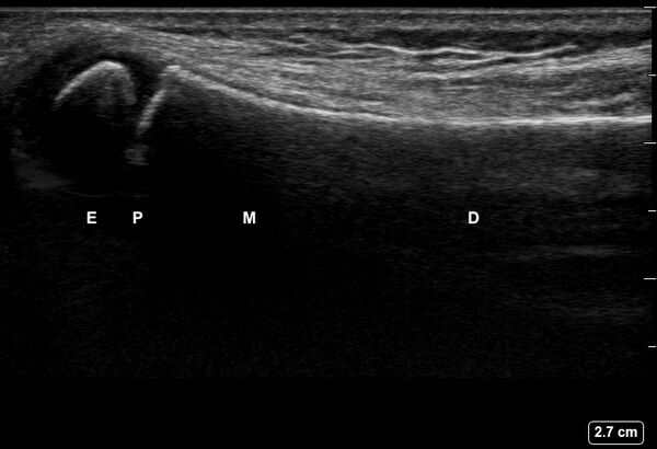 Pediatric Distal Forearm Fractures/Ultrasound Diagnosis