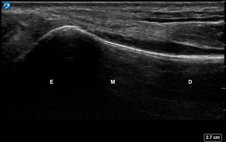 Pediatric Distal Forearm Fractures: Ultrasound Diagnosis