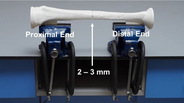 Uniplanar External Fixation for an Open Tibial Shaft Transverse Fracture
