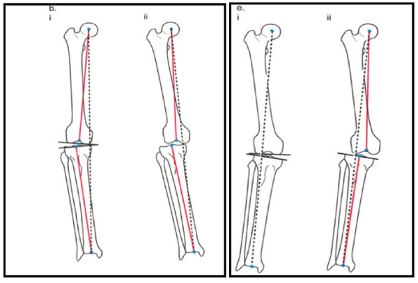 Deformity Correction of Lower Limb Bones/Basic Principles/Malalignment ...
