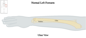Pediatric Distal Forearm Fractures/Anatomy Review