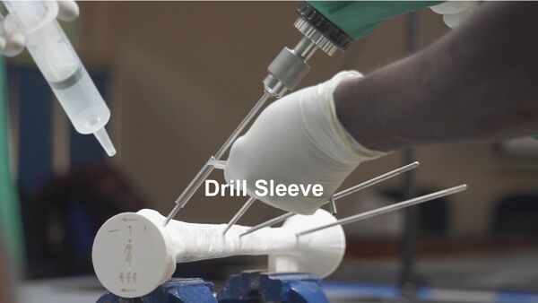 Modular External Fixation for Tibial Fracture