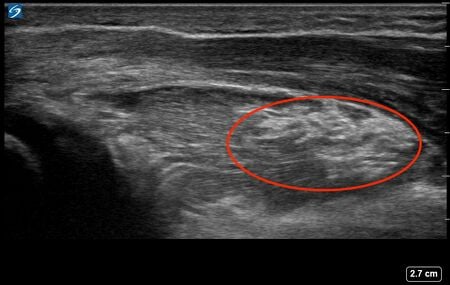 Pediatric Distal Forearm Fractures/Ultrasound Diagnosis