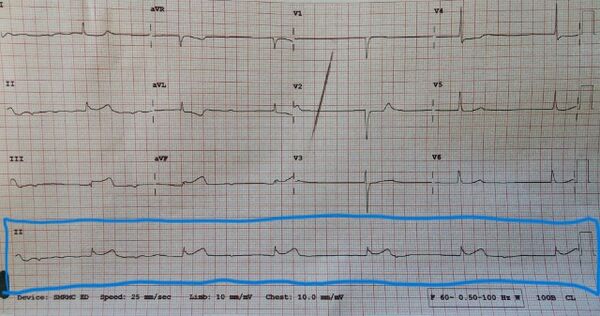 12 Lead EKG Interpretation - Appropedia, the sustainability wiki