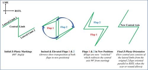 Z-Plasty Background - Appropedia, the sustainability wiki