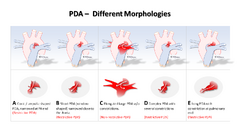 PDA Pathophysiology and Anatomy