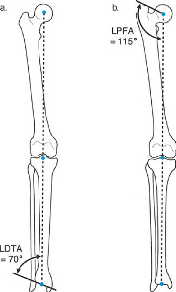 Deformity Correction of Lower Limb Bones