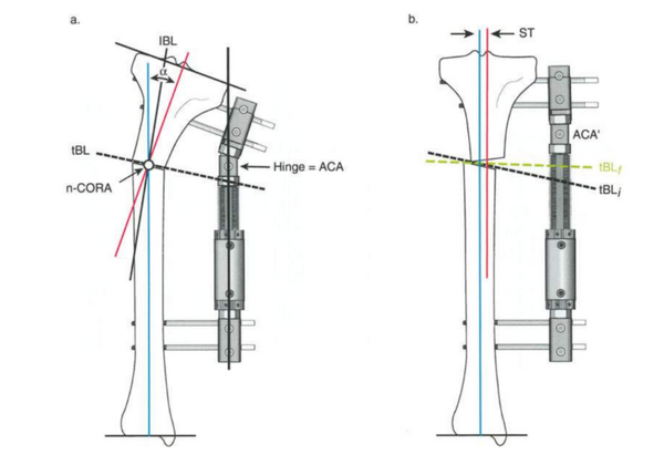 Deformity Correction of Lower Limb Bones/Basic Principles/External ...