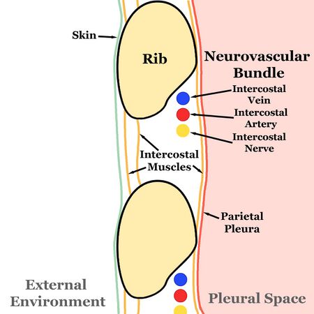 Needle Decompression - Appropedia, the sustainability wiki