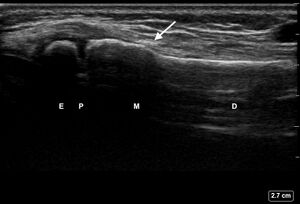 Pediatric Distal Forearm Fractures/Ultrasound Diagnosis