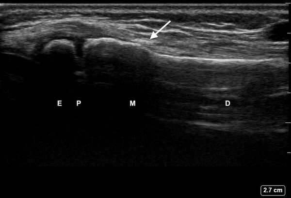 Pediatric Distal Forearm Fractures/Ultrasound Diagnosis