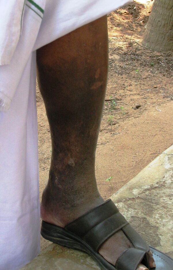 Diabetes mellitus cured - George's experience