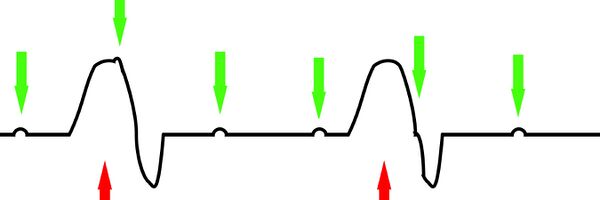 EKG Rhythm Interpretation - Appropedia, the sustainability wiki