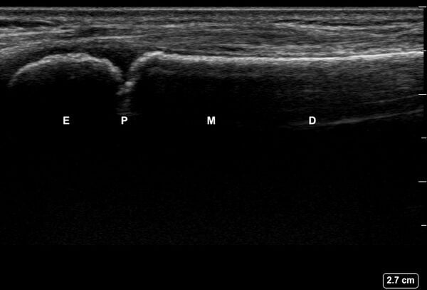 Pediatric Distal Forearm Fractures/Ultrasound Diagnosis
