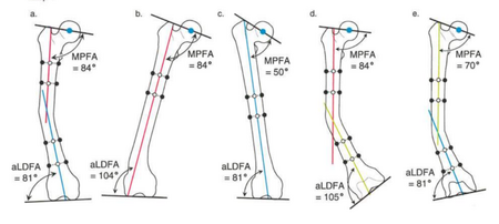 Deformity Correction of Lower Limb Bones/Basic Principles/Rules of Bone ...