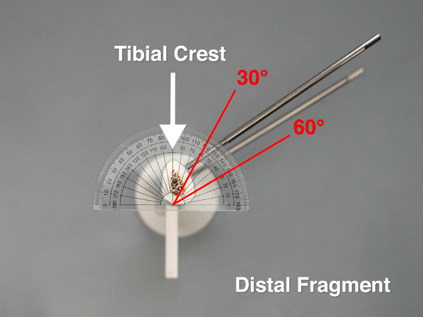 Uniplanar External Fixation Knowledge Review