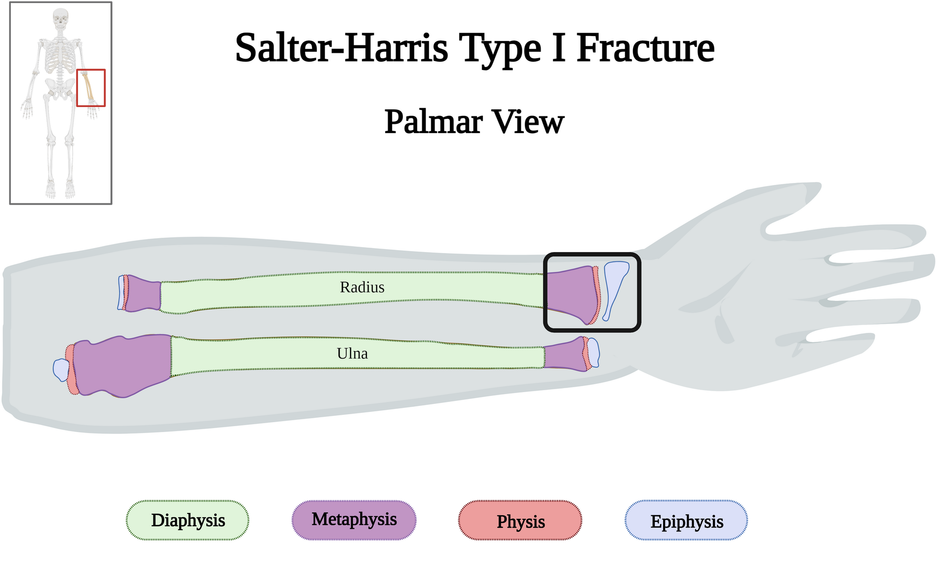 Index of /w/images/thumb/b/bb/Salter-Harris_Type_I_Fracture_of_Left ...