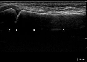 Index of /w/images/thumb/c/c4/Ultrasound_Labelled_Scan_-_Lateral_Ulna ...