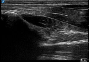 Pediatric Distal Forearm Fractures/Ultrasound Diagnosis of Pediatric ...