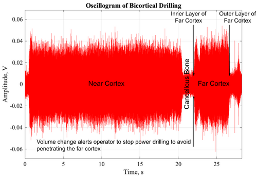Index of /w/images/thumb/e/ea/Oscillogram_of_Bicortical_Drilling_of ...