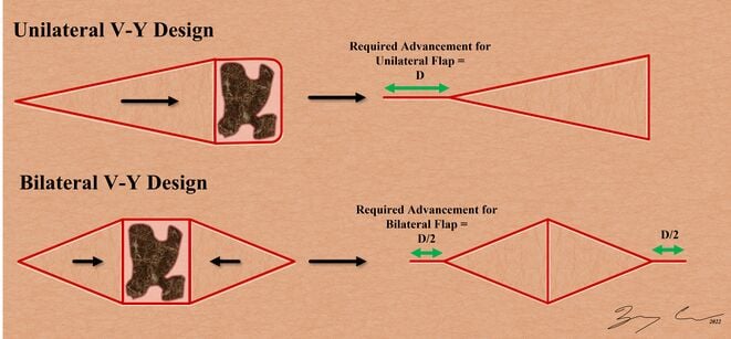 V-Y Advancement Flap - Background