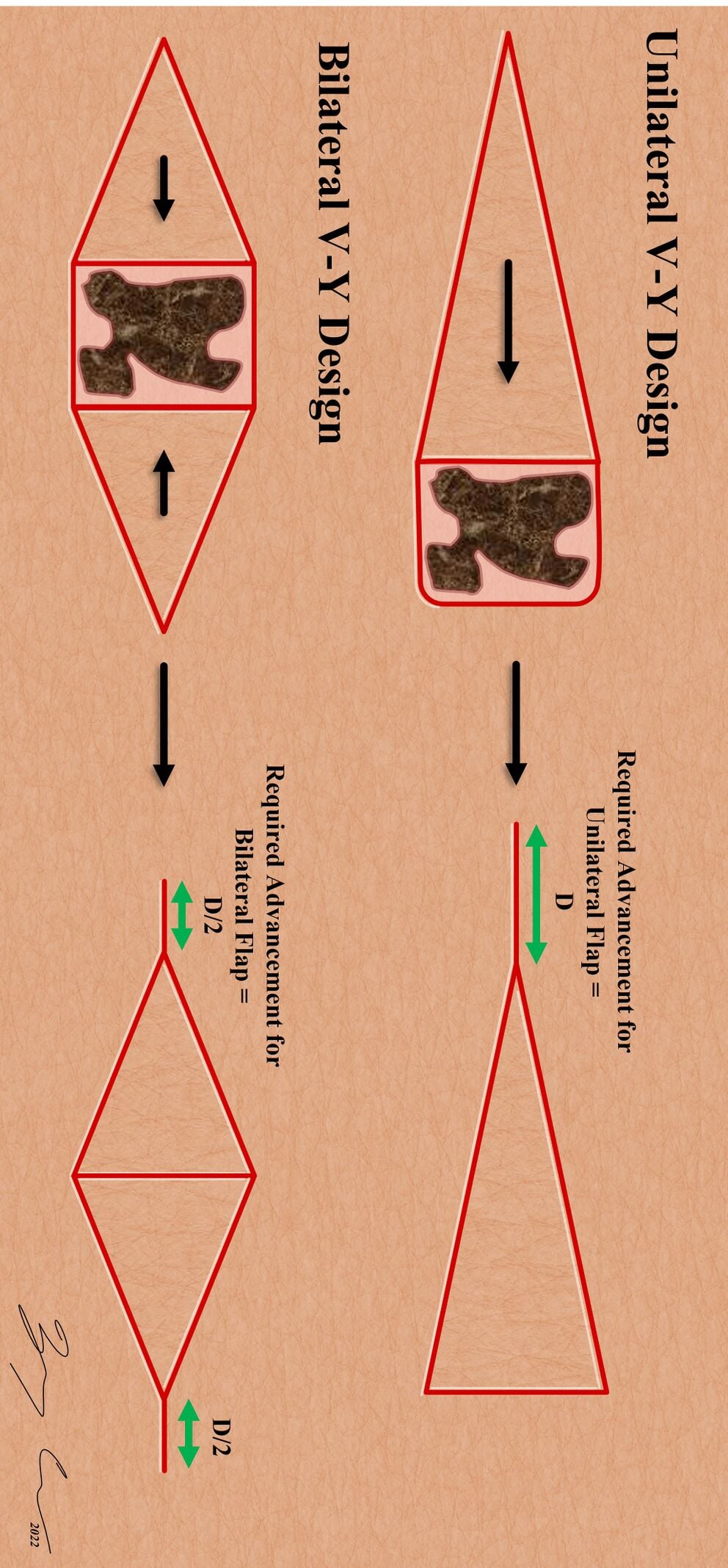 V-Y Advancement Flap/Background