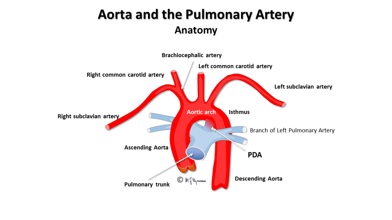 PDA Pathophysiology and Anatomy