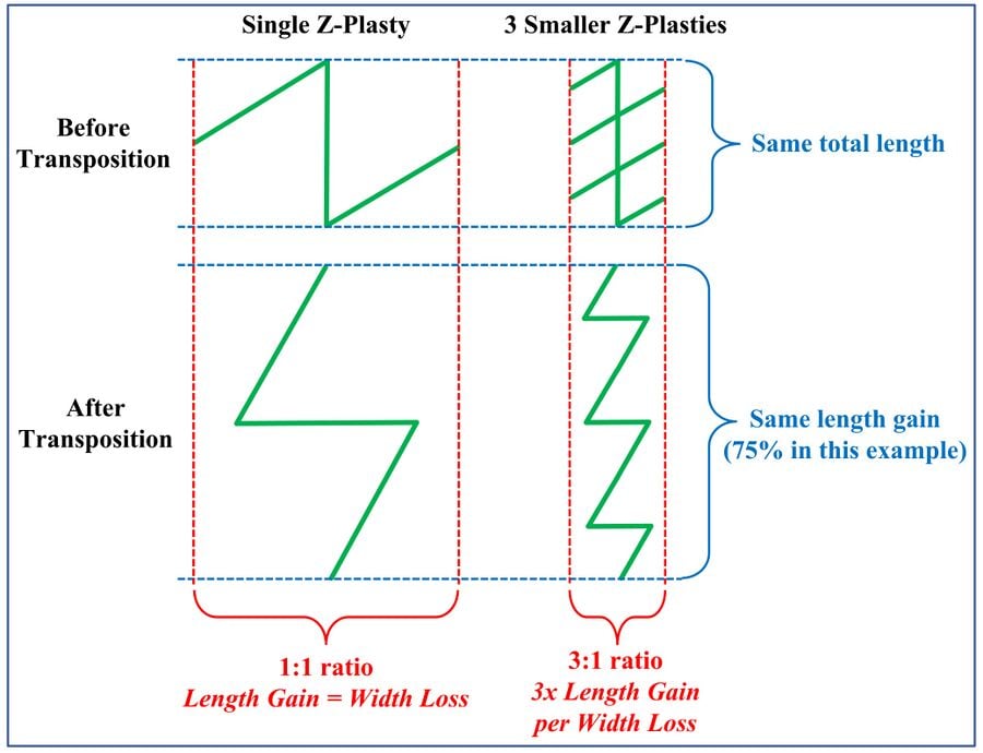 Z-Plasty/Summary