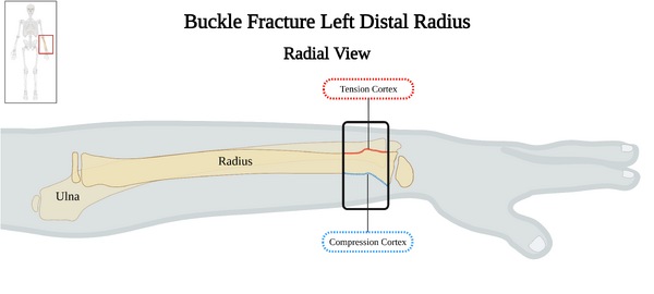 Pediatric Distal Forearm Fractures/Anatomy Review